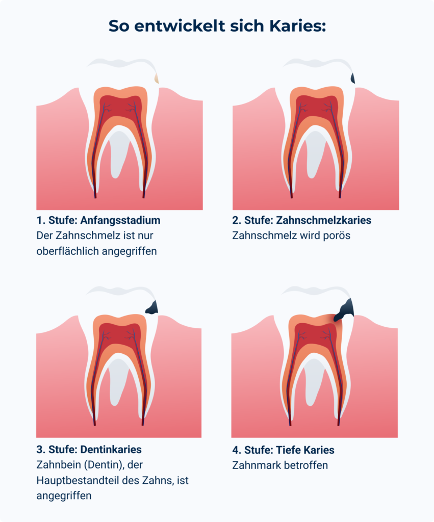 Wie entsteht Karies? Symptome erkennen | Doctolib