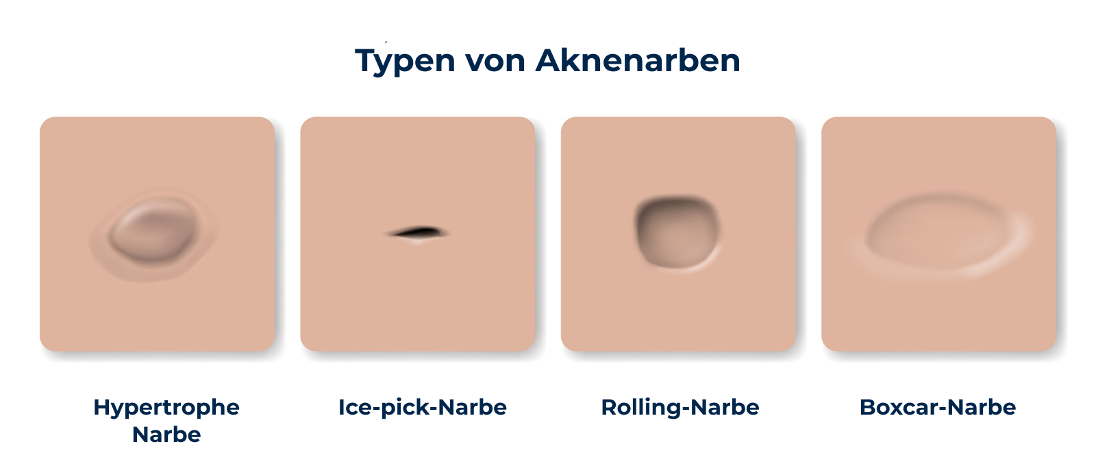 Aknenarben entfernen: Was hilft? | Methoden zur Entfernung