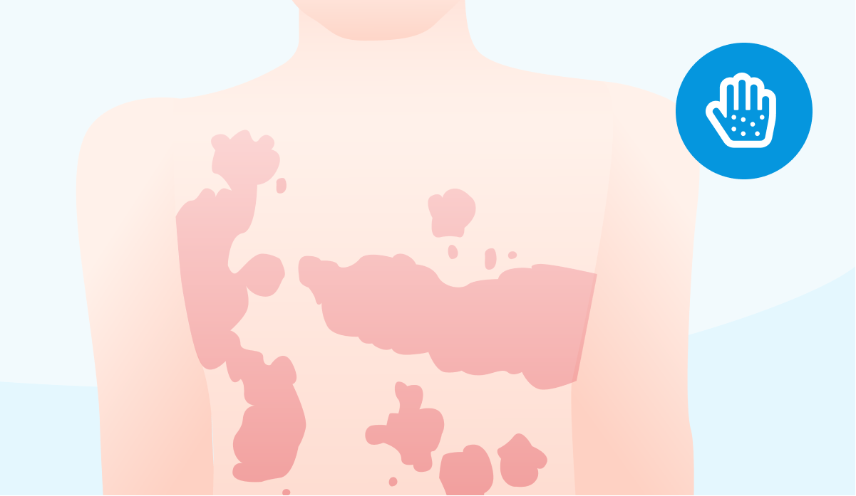 Orticaria: cos'è, cause e sintomi | Doctolib