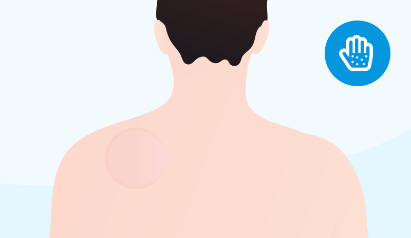 Petecchie: i sintomi, le cause e le cure | Doctolib