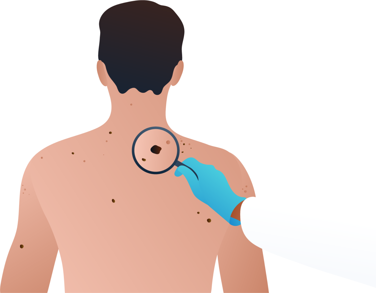 Nei maligni: prevenzione e trattamenti | Doctolib