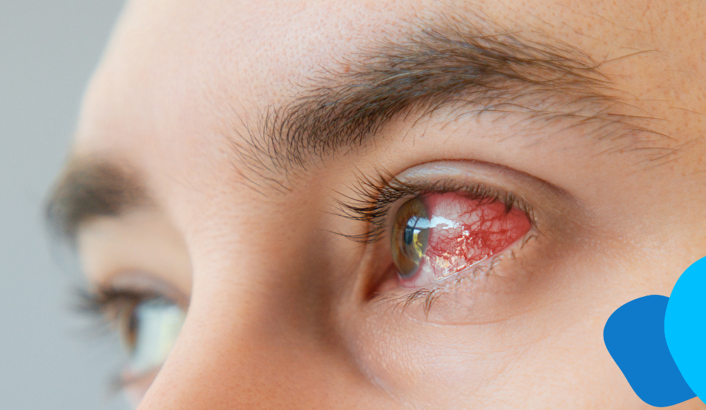 Cheratite: sintomi, cause, cure | Doctolib