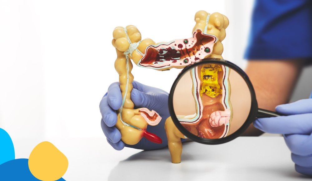 Diverticolosi del sigma: sintomi, cure - Doctolib