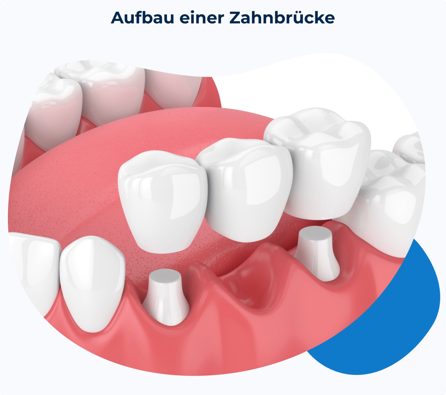 Was ist eine Zahnbrücke? Arten, Kosten & Ablauf | Doctolib