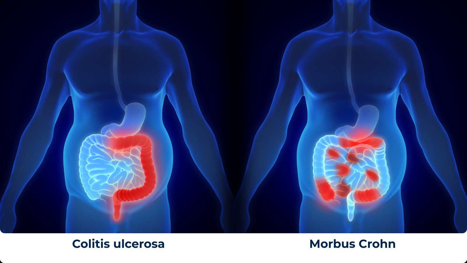 Chronisch-entzündliche Darmerkrankungen (CED): Ein Überblick