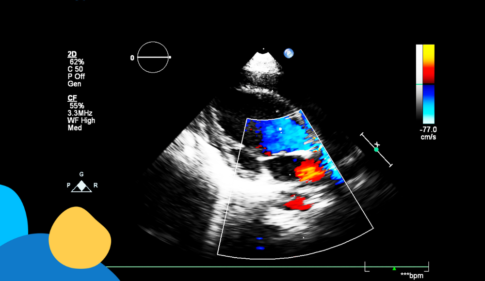 Ecocardiogramma transesofageo: sedazione, rischi