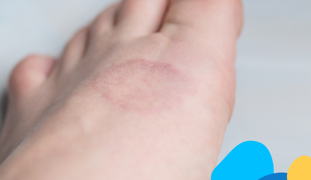 Dermatofitosi: sintomi, cause, cure - Doctolib