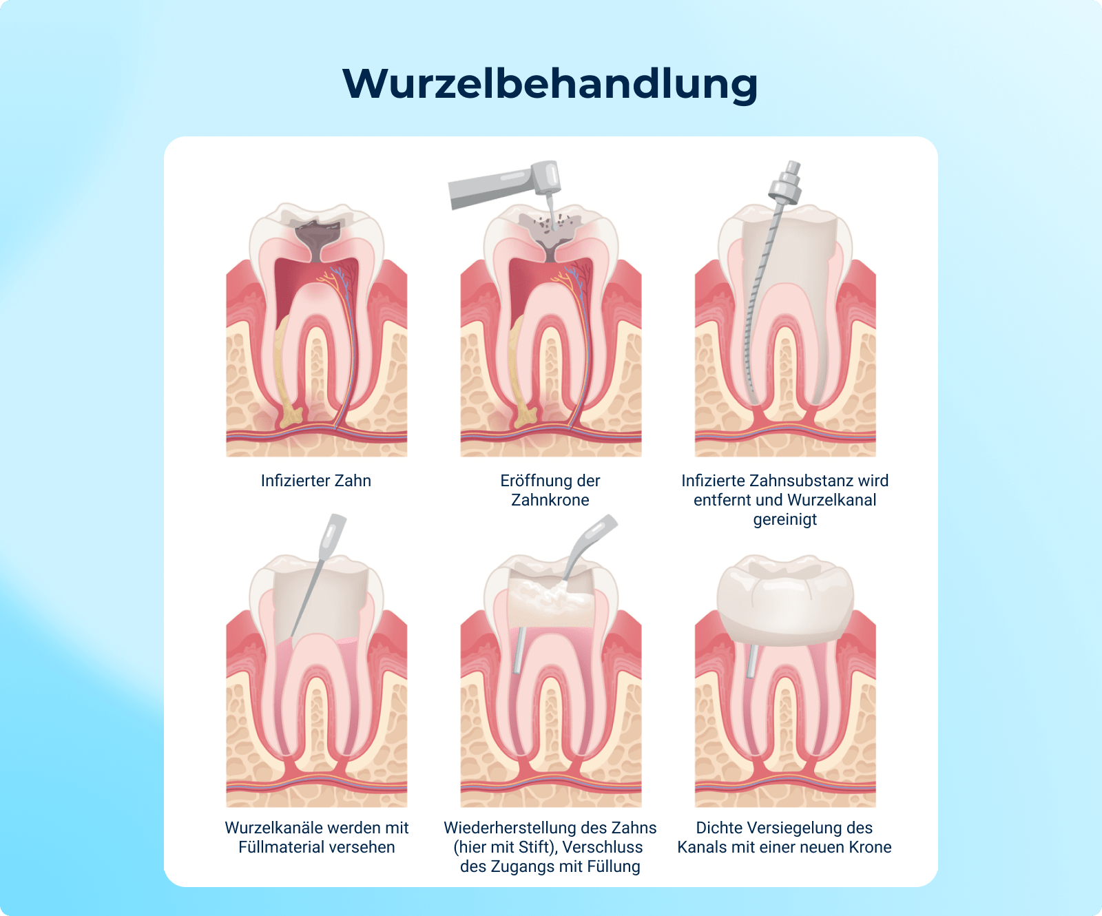 Wurzelbehandlung: Ablauf, Dauer und mögliche Kosten | Doctolib