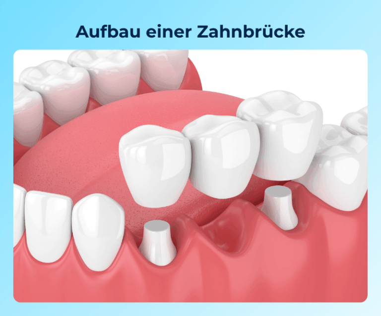 Was ist eine Zahnbrücke? Arten, Kosten & Ablauf | Doctolib