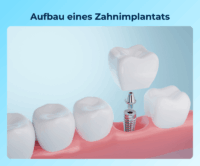 Implantat oder Brücke: Wann ist was sinnvoller? | Doctolib