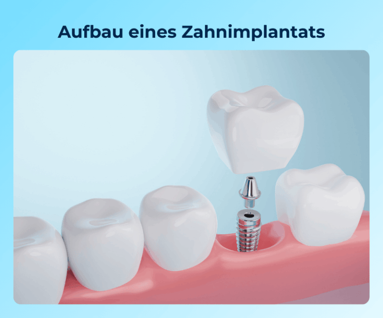 Implantat oder Brücke: Wann ist was sinnvoller? | Doctolib